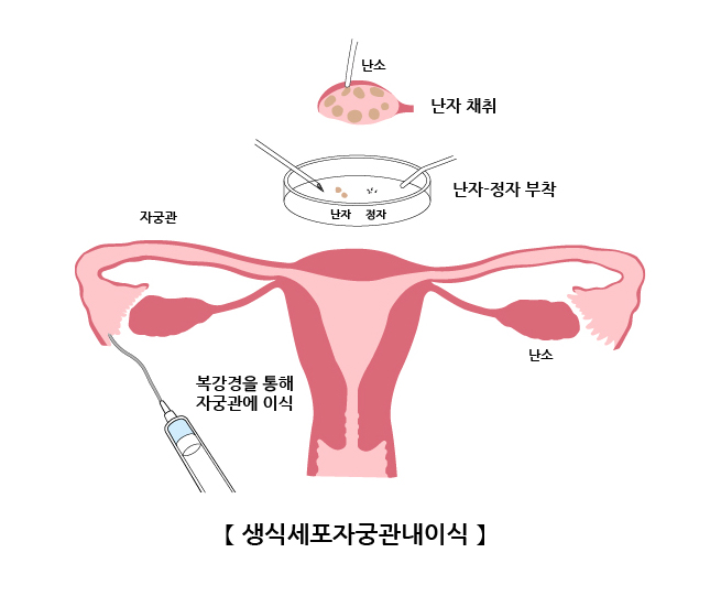 생식세포자궁관내이식 검사시술수술정보 의료정보 건강정보 서울아산병원