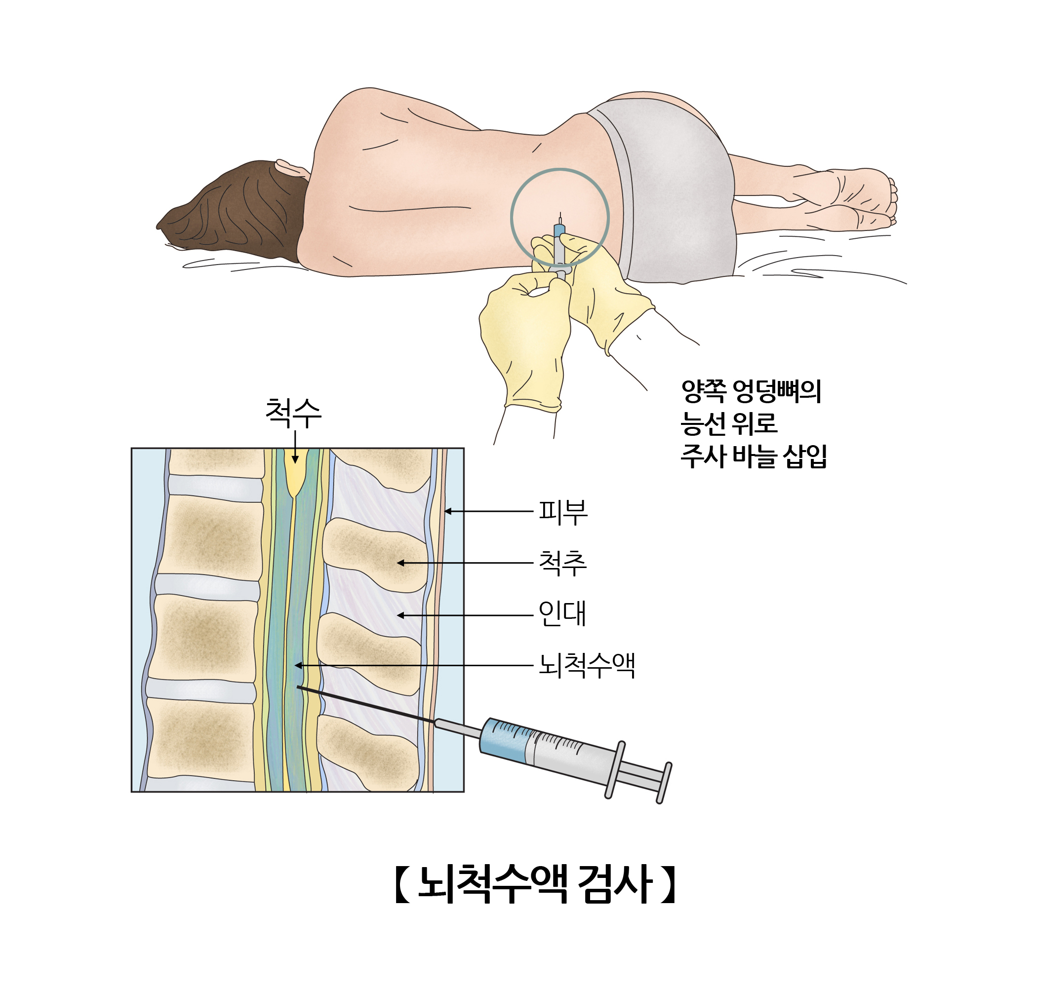 뇌척수액 검사 검사시술수술 정보 의료정보 건강정보 서울아산병원