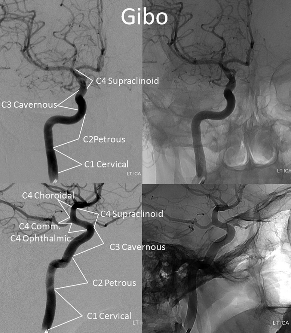 내경 동맥 다양한 해부학적 분류 (ICA segment anatomy) | 신경중재최근동향 | 커뮤니티 | 신경중재클리닉 ...